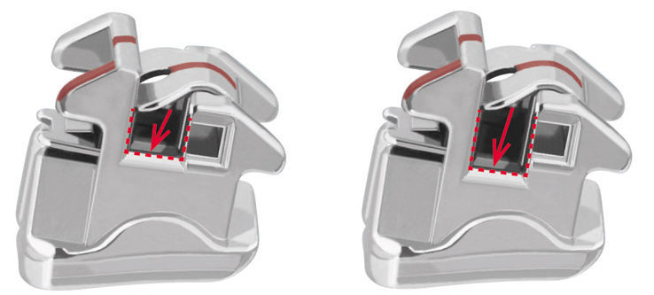 Bracket de metal - BioPassive® - FORESTADENT BERNHARD FÖRSTER GMBH ...