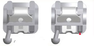 Bracket de metal - BioPassive® - FORESTADENT BERNHARD FÖRSTER GMBH ...