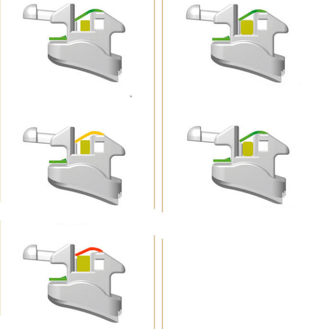Bracket de metal - BioPassive® - FORESTADENT BERNHARD FÖRSTER GMBH ...