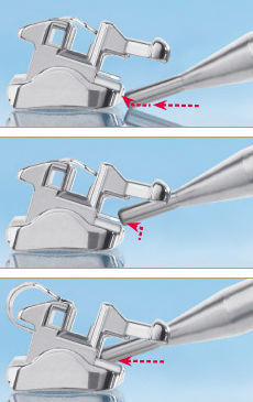 Bracket de metal - BioPassive® - FORESTADENT BERNHARD FÖRSTER GMBH ...