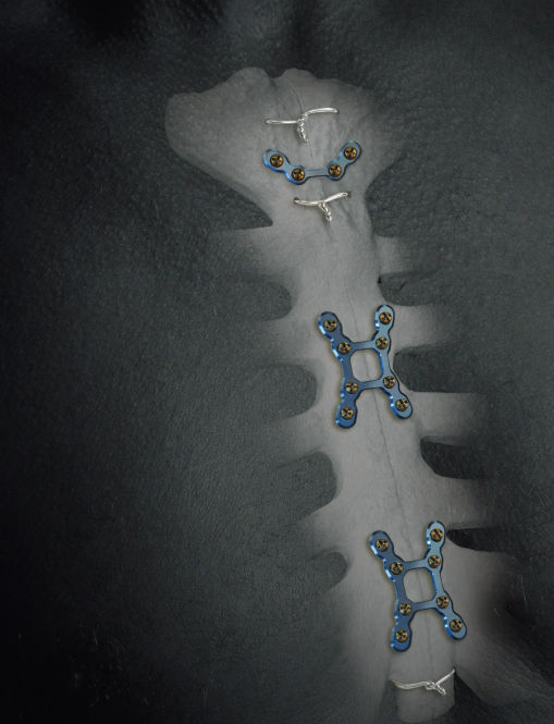 Placa de compresión para esternón - SternaLock® - Zimmer Biomet ...