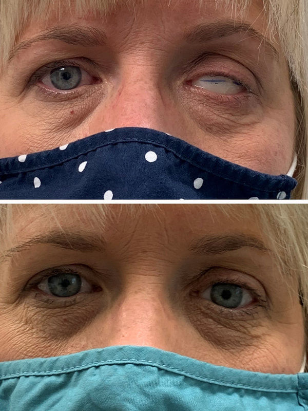 Prótesis estética esterna ocular - The Anaplastology Clinic - para adulto