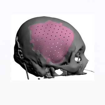 Implante craneal a medida - Recranio™ - Medprin Biotech