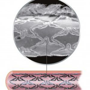 Stent arteria coronaria - DES – Cre8™ - Alvimedica - de cromo cobalto ...