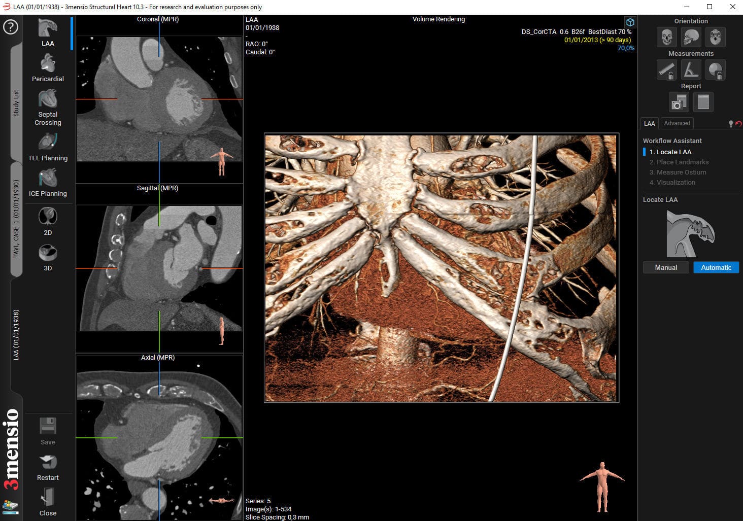 Módulo de software médico - 3mensio LAA - Pie Medical Imaging - de ...