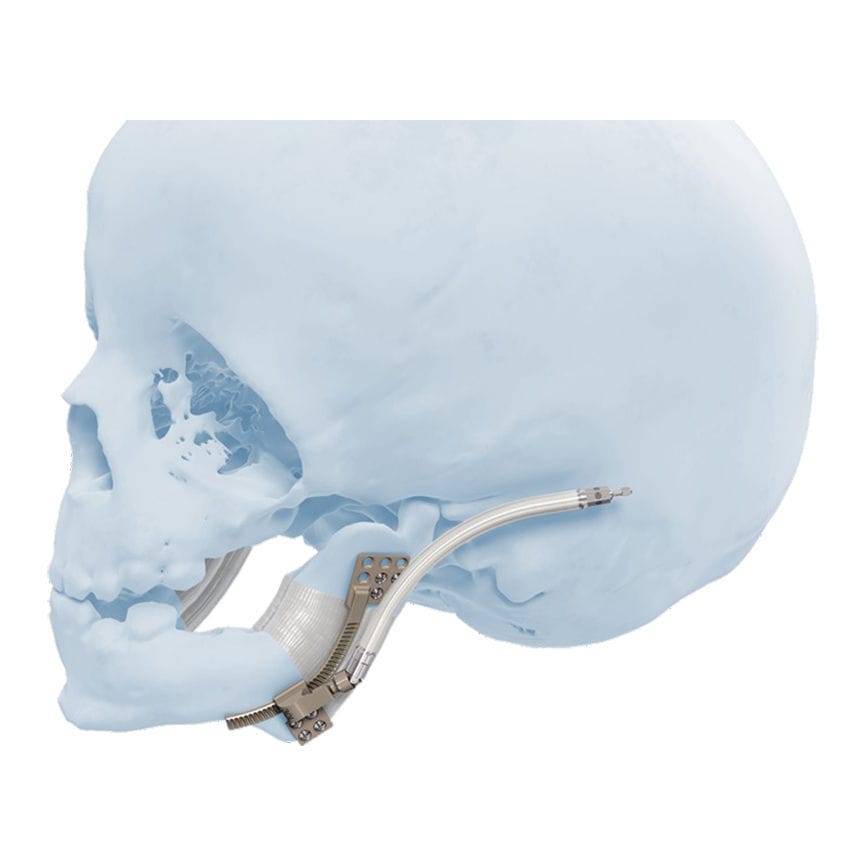 Distractor mandibular - CMF Curvilinear - Depuy Synthes - interno ...
