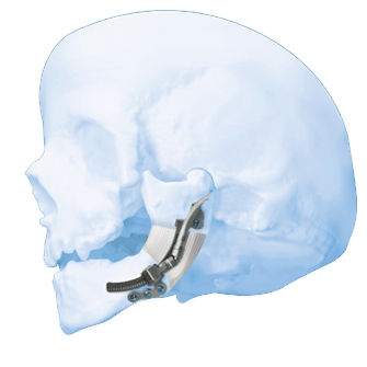 Distractor mandibular - CMF Curvilinear - Depuy Synthes - interno ...