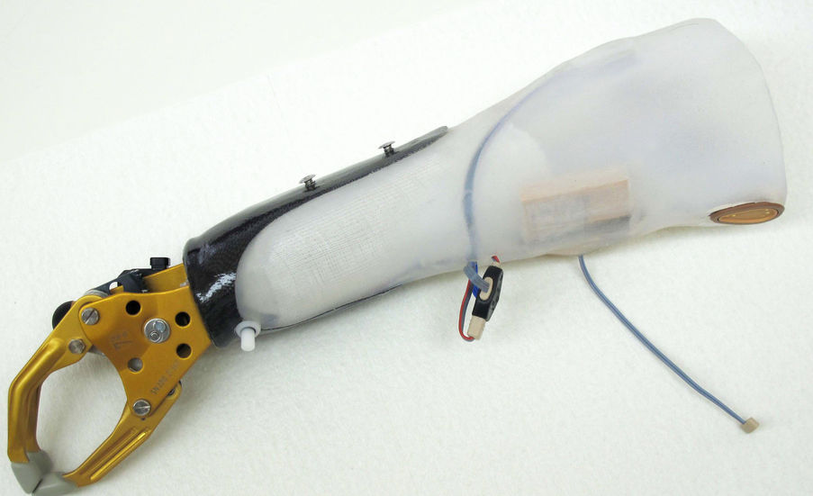 Prótesis de mano mioeléctrica - Aesthetic Prosthetics - pinza gancho ...