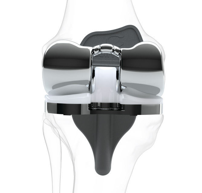 Prótesis de rodilla tricompartimental - iTotal PS - ConforMIS - de ...