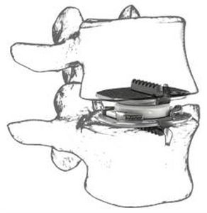 Prótesis de disco lumbar - Mobidisc® - LDR Medical - Vídeos