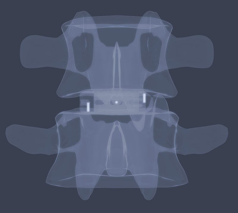 Caja intersomática lumbar - ROI-T® - LDR Medical - vía transforaminal ...