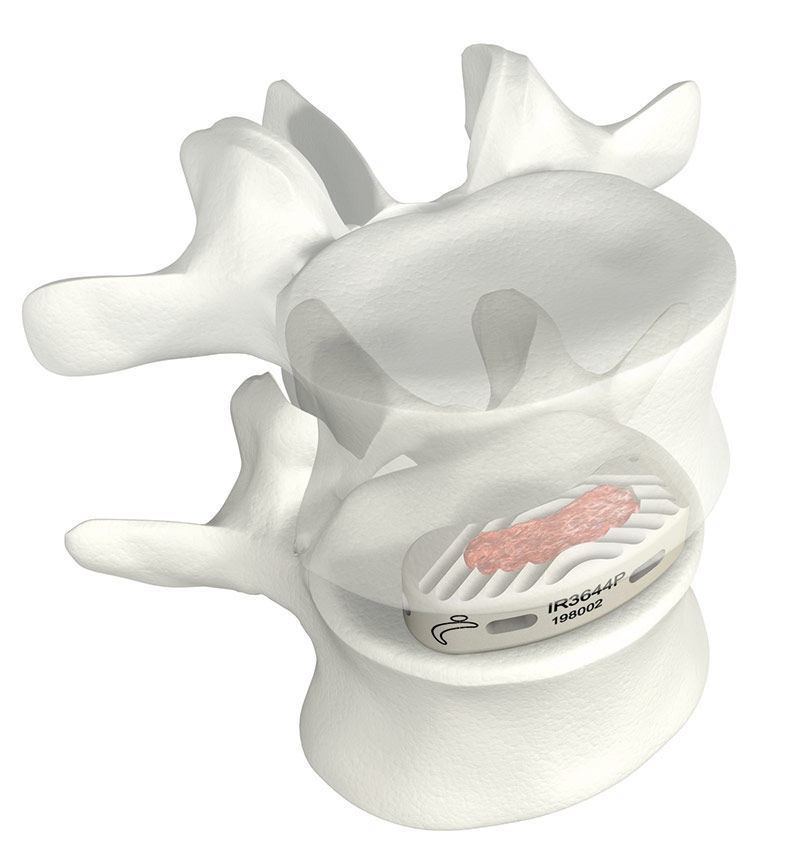 Caja intersomática lumbar - ROI-T® - LDR Medical - vía transforaminal ...
