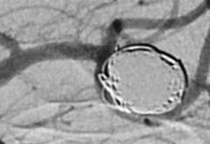 Stent intracraneal - pCONus - Phenox - de metal
