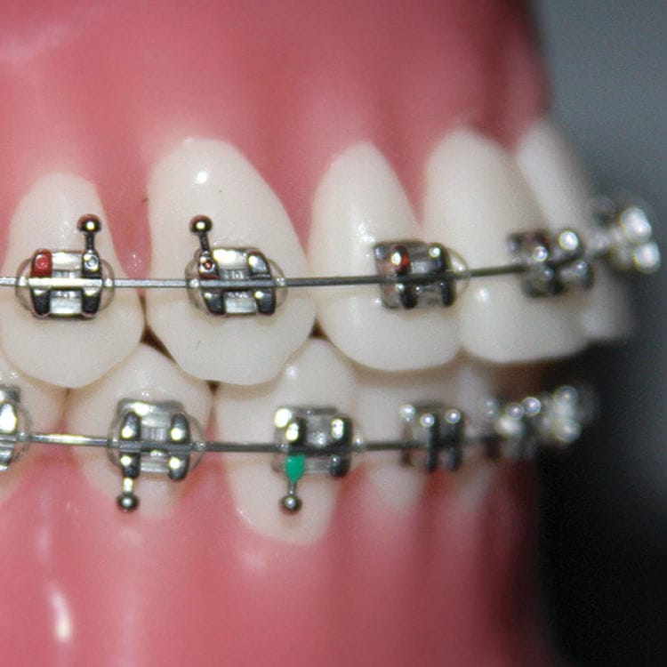 Bracket de metal - Focus™ - G&H Orthodontics - mini