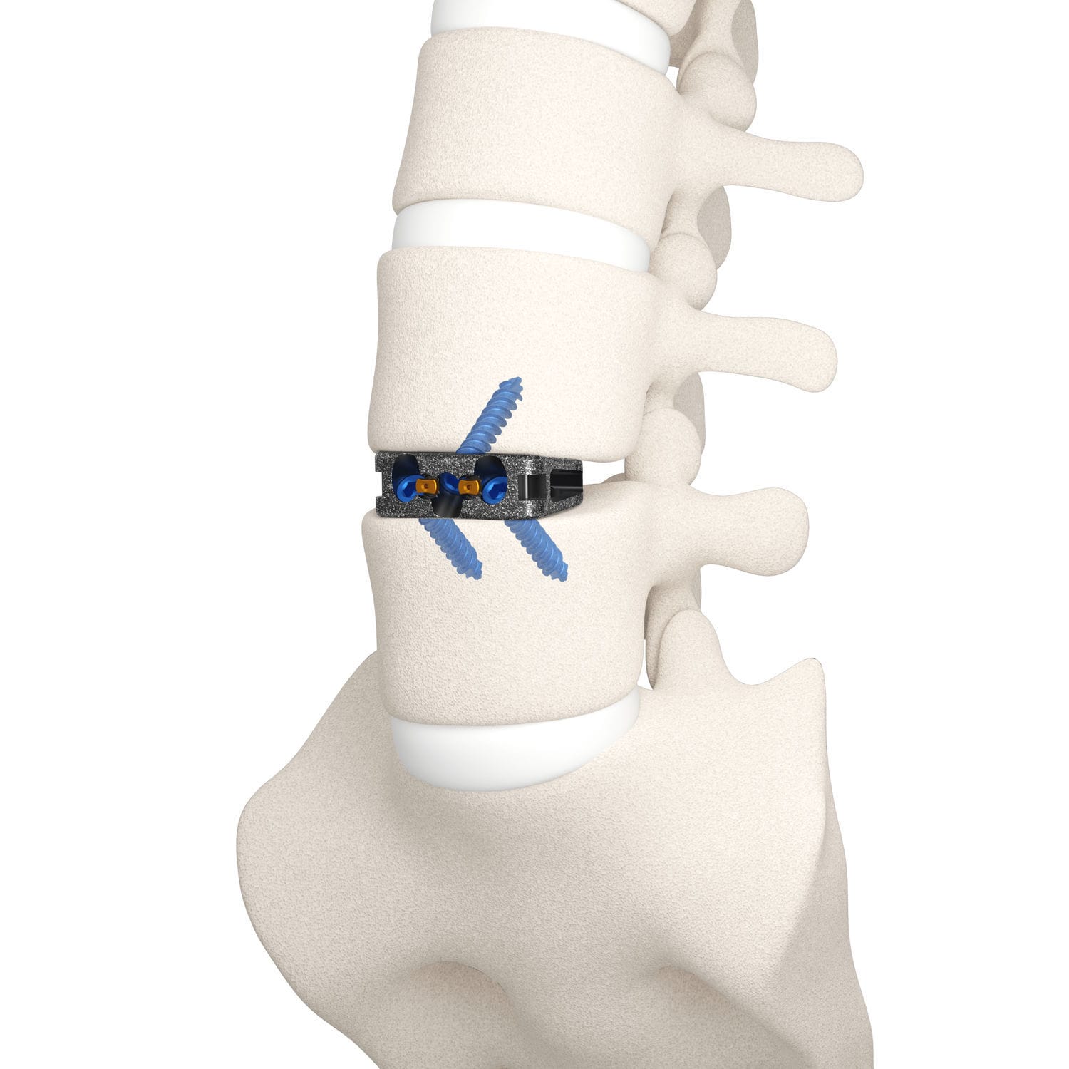 Caja intersomática lumbar - DYNA-LINK® - Life Spine - vía anterior / de ...
