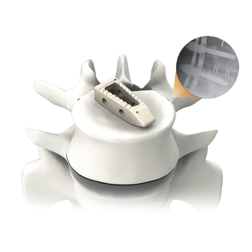 Caja intersomática toracolumbar - PLATEAU®-P - Life Spine - vía ...