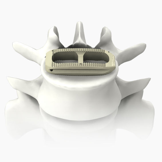 Caja intersomática lumbar - PLATEAU®-X - Life Spine - vía lateral / de PEEK