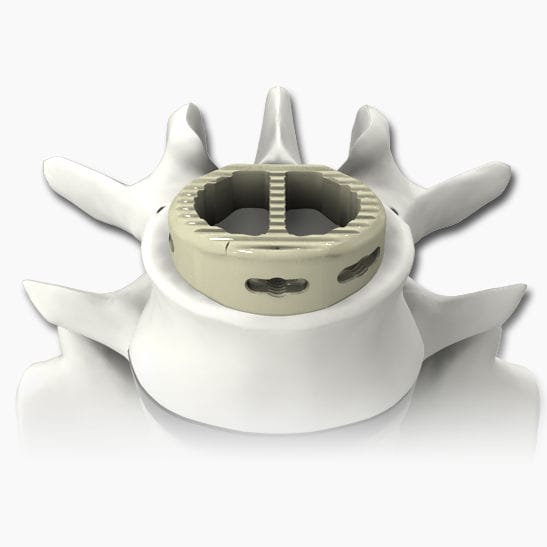 Caja intersomática lumbar - PLATEAU®-A - Life Spine - vía anterior / de ...