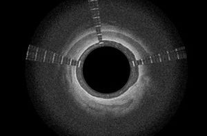 Catéter de tomografía de coherencia óptica / vaso sanguíneo - Ocelot ...