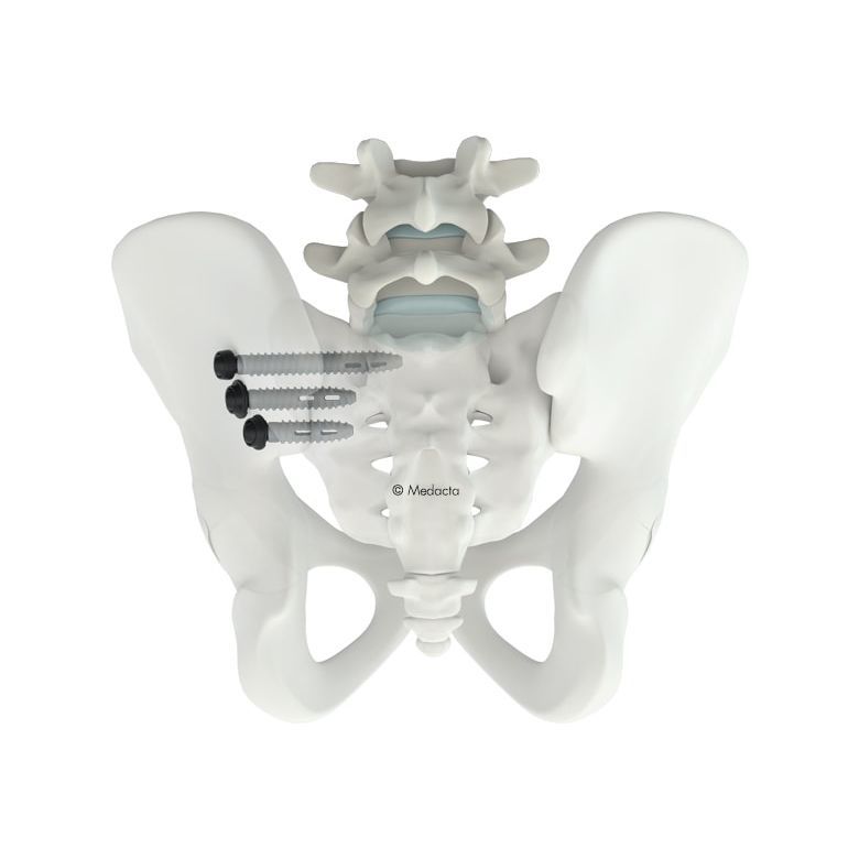 Sistema de osteosíntesis sacroilíaco - M.U.S.T.® SI - Medacta - vía ...