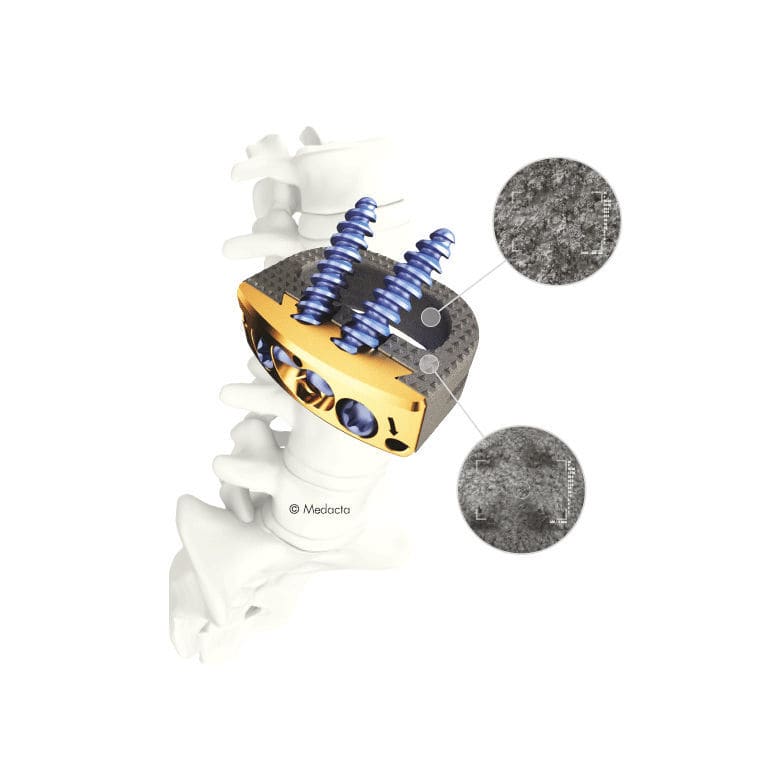 Caja intersomática lumbar - MectaLIF® - Medacta - vía anterior / vía ...