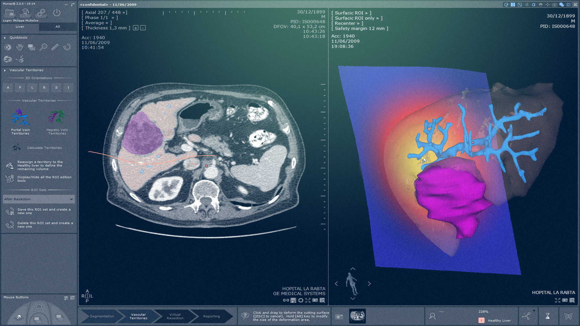 Módulo de software de análisis - MYRIAN®XP-LIVER MRI - Intrasense - de ...