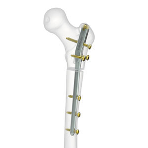 Clavo intramedular para fémur - D-SCOPE - Peditst - fijación proximal ...
