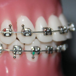Bracket de metal - Agility® - G&H Orthodontics - autoligante