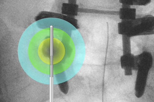 Electrodo de estimulación - RCE - Cosman Medical - quirúrgico ...