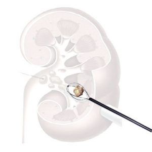 Cesta endoscopica para extracción de cálculos renales - PerkX - ROCAMED ...