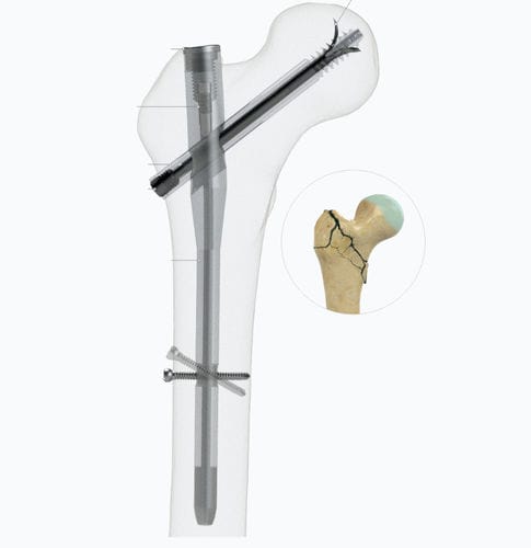 Clavo intramedular para fémur - Zimed Medical - fijación proximal ...