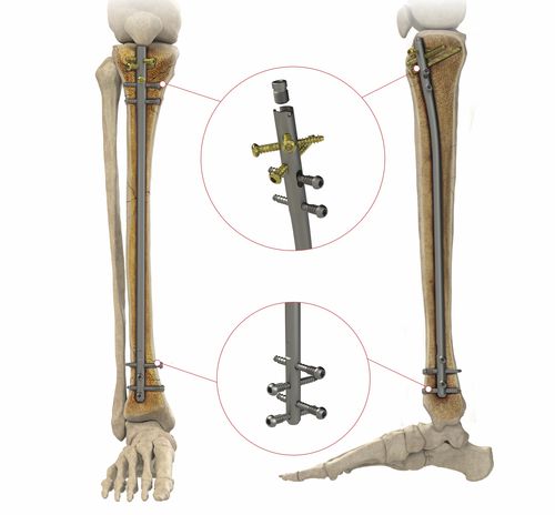 Clavo intramedular para tibia - AS.ATN.401 - Ases Orthopedics ...