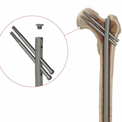 Clavo intramedular para fémur - 4T1-4001050 - Ases Orthopedics ...