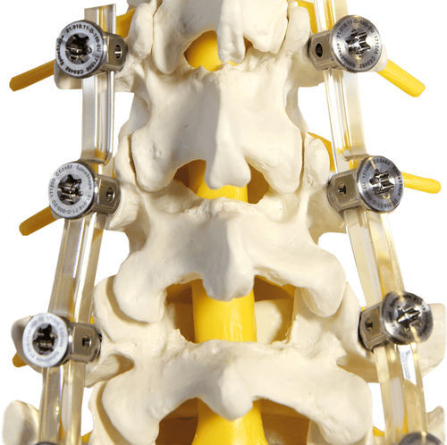 Sistema de osteosíntesis lumbar - SpineShape System IV - SpineSave ...
