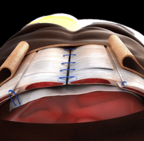 Matriz tisular cirugía ortopédica - XCM Biologic™ - Depuy Synthes