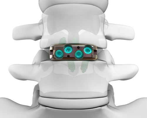Caja intersomática lumbar - DYNA-LINK® ELITE - Life Spine - vía anterior