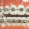 Bracket de metal - Synergy FX® - Rocky Mountain Orthodontics (RMO®)
