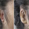 Prótesis estética esterna auricular - Prosthetic Artists - para adulto