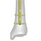 Clavo intramedular para tibia - TDM - fijación proximal / fijación ...