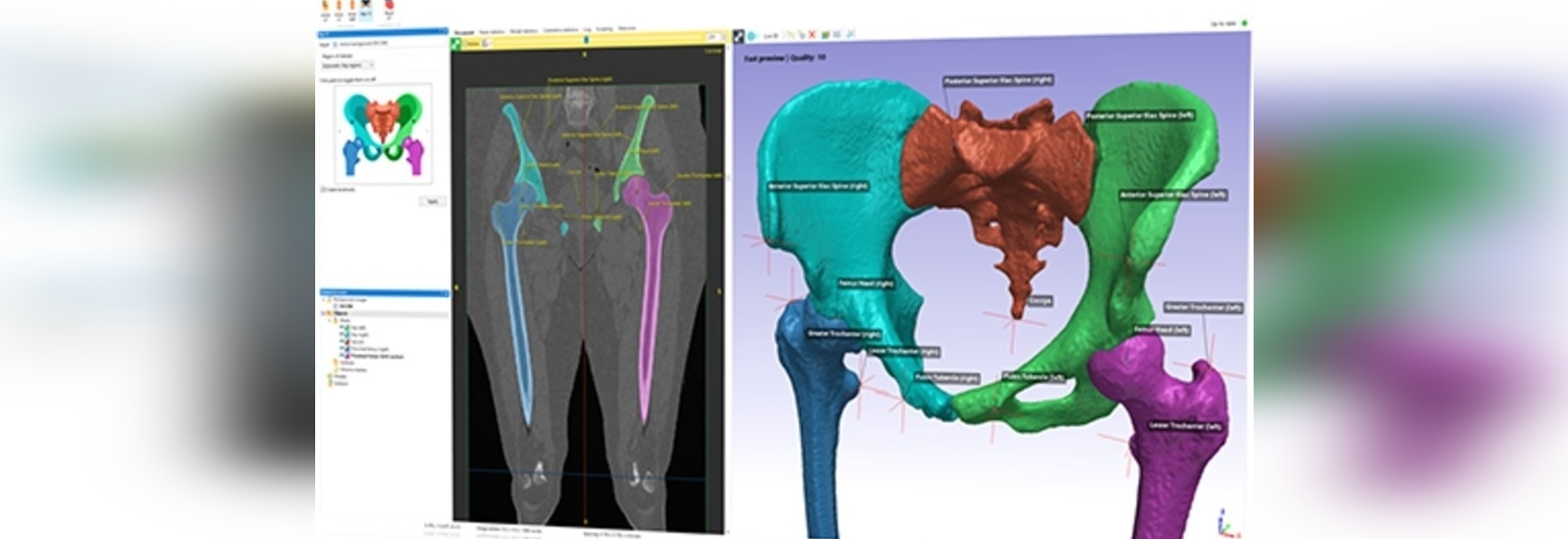 Webinar: Segmentación de imágenes médicas mediante IA con el software ...